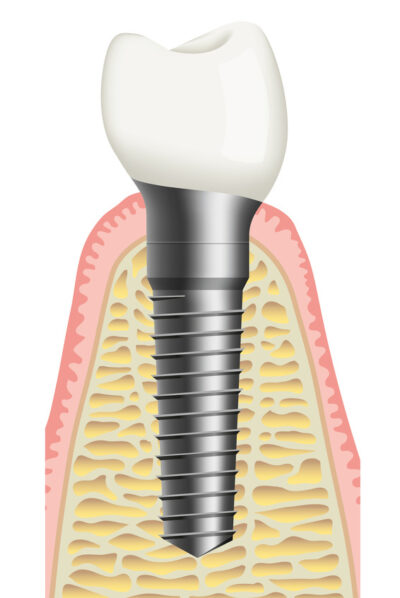 Bone-Level oder Tissue-Level – welches Implantat ist besser?