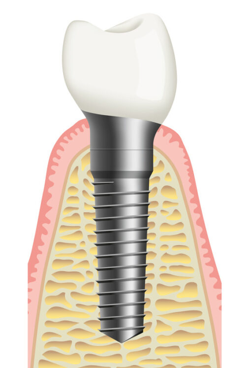 Bone-Level oder Tissue-Level – welches Implantat ist besser?