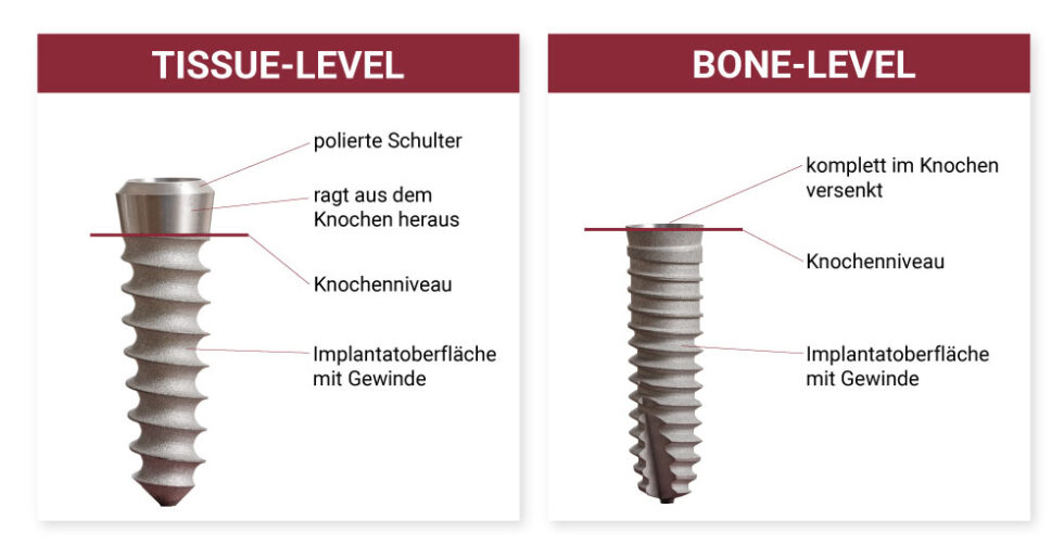 Bone-Level oder Tissue-Level – welches Implantat ist besser?